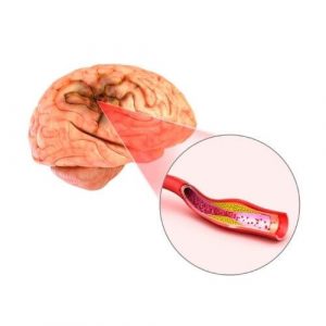 Brain Stroke Types, Facts Causes, Symptoms, Diagnosis, And Treatment ...