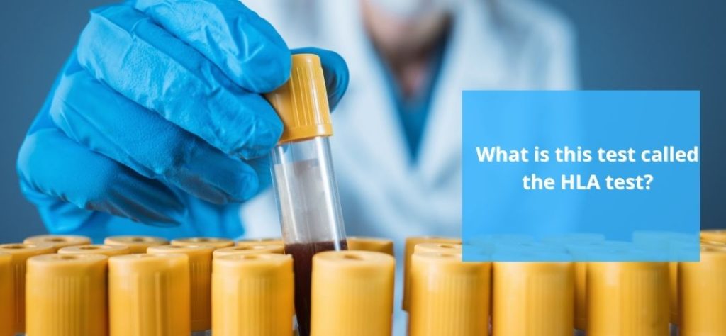 HLA Test In Chandigarh @ Best Price With HealthFinder